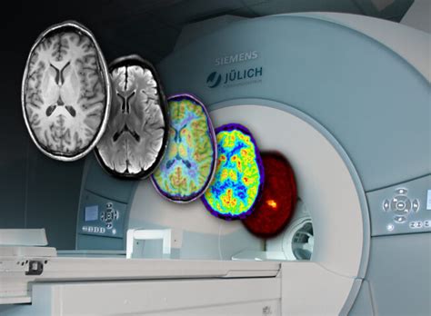New AI Tool For Brain Tumor Diagnostics Kompass Des Forschungsbereichs Information