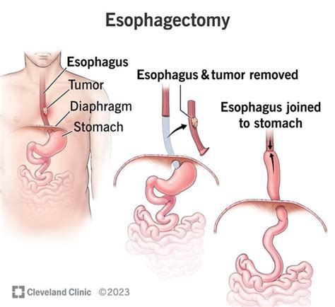 Oesophagectomy Surgery Patients Guide To Before During And After