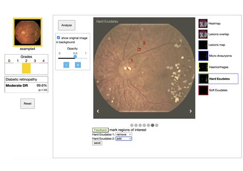 Interpretable And Interactive Disease Diagnosis Using Collaborative