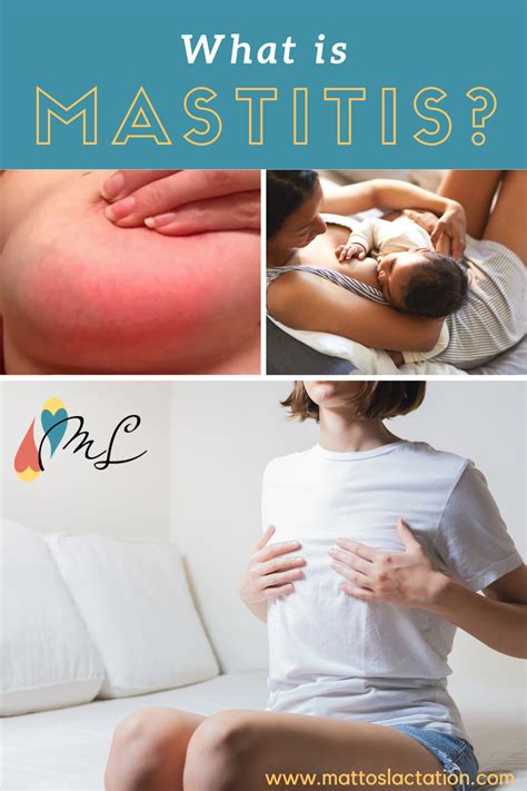 Best 13 Your Most Common Mastitis Questions Answered Artofit