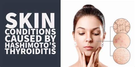 15 Skin Conditions Caused By Hashimotos And Hypothyroidism
