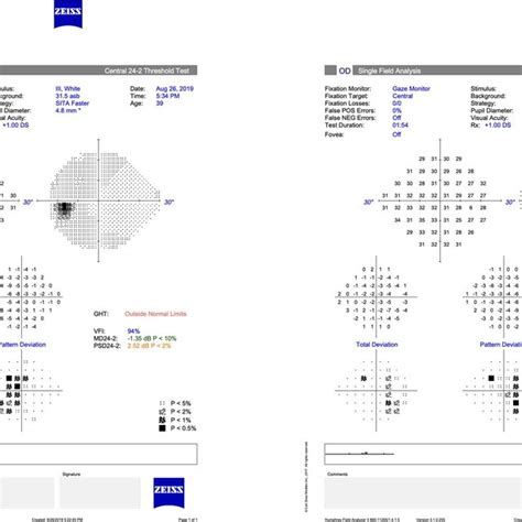 Humphrey 24 2 Visual Field Illustrating Enlarged Blind Spots With Download Scientific Diagram