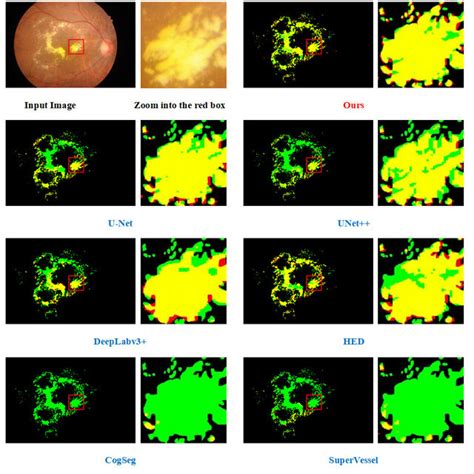 Examples Of Some Difficulties In Hard Exudates Segmentation Some Hard
