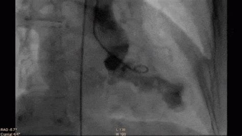 Tako Tsubo Cardiomyopathy  Wiffle