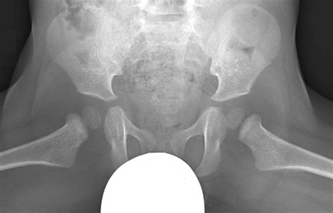 X Ray Shielding Why Lead Aprons May Be A Thing Of The Past