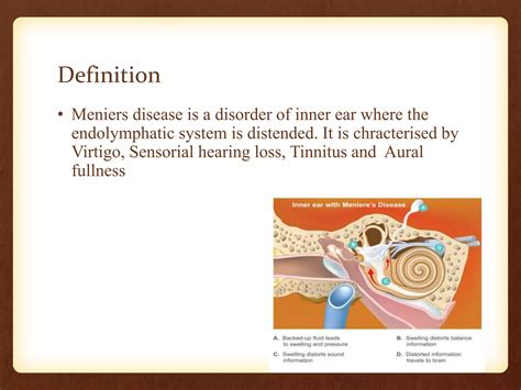 Menieres Disease Pptx