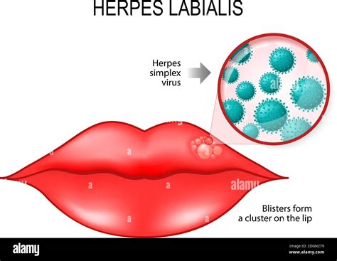 Herpes Labialis Diagram Novel Drug Blocks Herpes Virus Link To