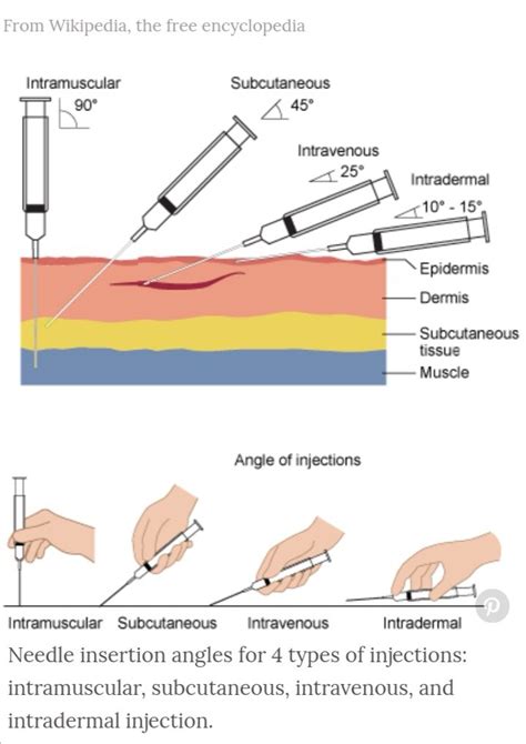 Intradermal Injection Sites