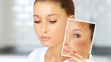 Home Remedies For Black Spot Removal Cremebellary Medium