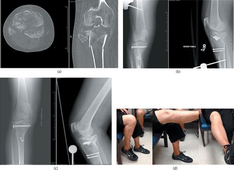 Proximal Tibial Fractures Musculoskeletal Key