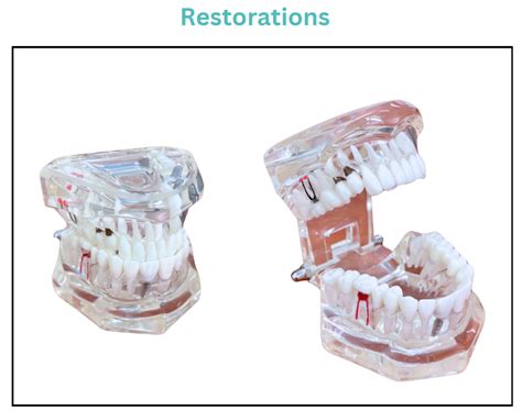 Demonstration Models Restoration Origin Dental Supplies