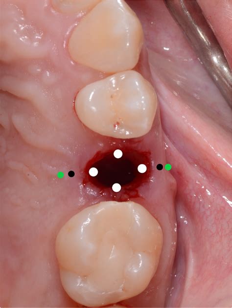 The White Spots Correspond To The Points Of The Post Extraction Socket Download Scientific
