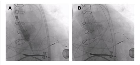 Tavr Medtronic Evolut R 34 Mm In A Patient With Pure Ar And A Left Download Scientific