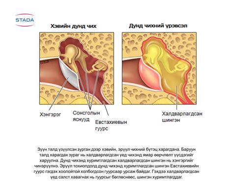 Stada Cis Mongolia 📍Чихний халдвар гэж юу вэ Чихний халдвар гэдэг нь чихэнд өвдөлт үүсгэх