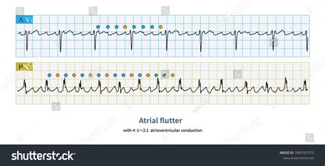Atrial Flutter Images Browse 288 Stock Photos Vectors Free Download With Trial Shutterstock