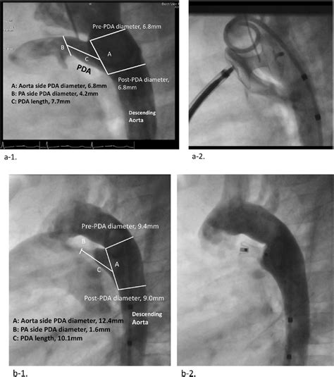 Type C PDA With CRS And Type A PDA Without CRS A Type C PDA Of A Download Scientific Diagram