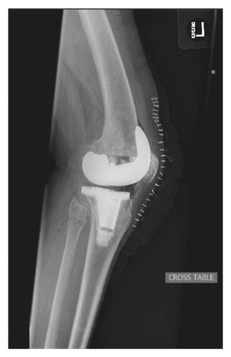 Postoperative Radiographs Postoperative Imaging Following Corrective