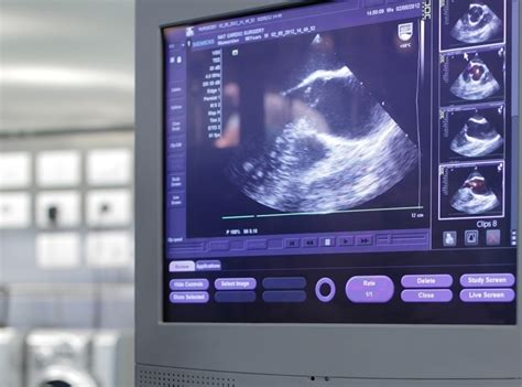 Stress Echo Cos Cardio