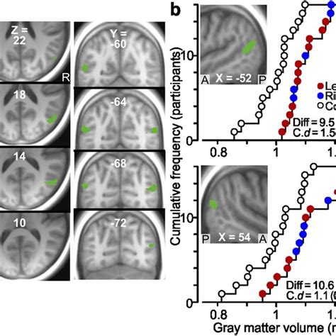 Increased Gray Matter Volume In Extrastriate Visual Areas Of Median Download Scientific Diagram