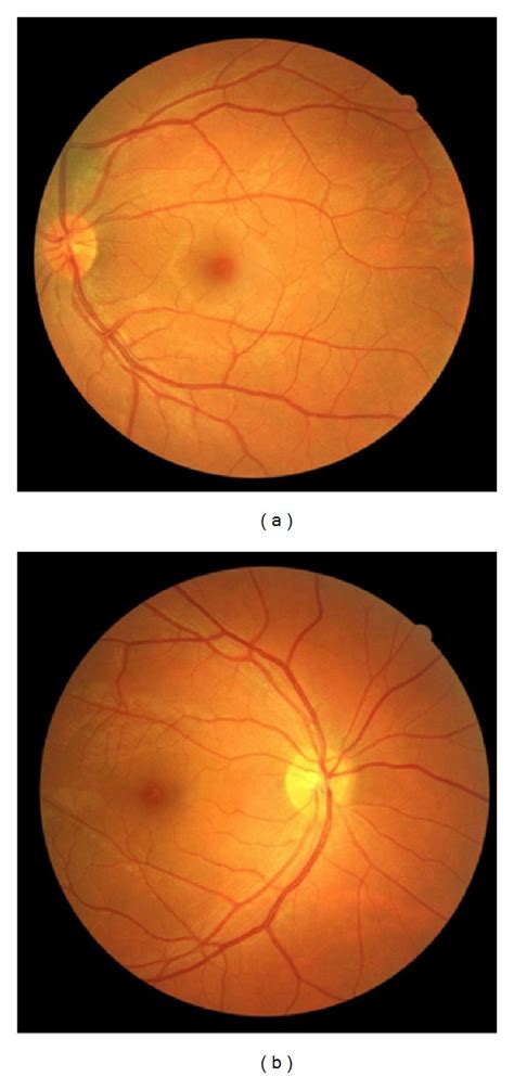 Fundus Photographes Of Both Eyes One Month After Cataract Surgery Of