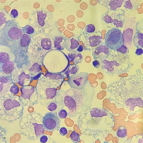 Body Fluid Monocytes Macrophages Medlabbuddy