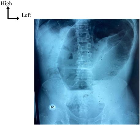 Recurrent Sigmoid Volvulus After Sigmoidectomy 3 Clinical Cases