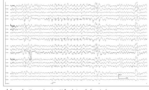 Figure 1 From A Novel Mutation In Lafora Disease And Update On Pathophysiology And Future
