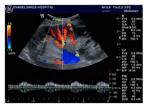 Spectral Doppler Ultrasound Image Shows A Tardus Parvus Waveform In An