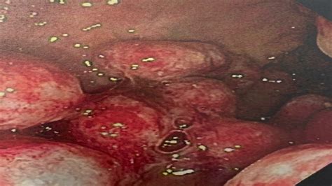 S2094 Polyp That Wears A Cap A Case Of Inflammatory Cap Pol Official Journal Of The