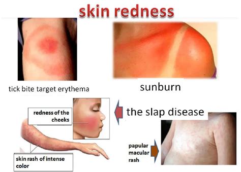 Diffuse Erythematous Rash