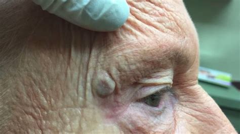 Dr Pimple Popper Tackles Massive Blackhead In Gross Yet Oddly Mesmerising Video Huffpost Uk Life
