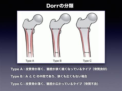 大腿骨の髄腔形状（dorrの分類） │ 整形外科のいろいろ