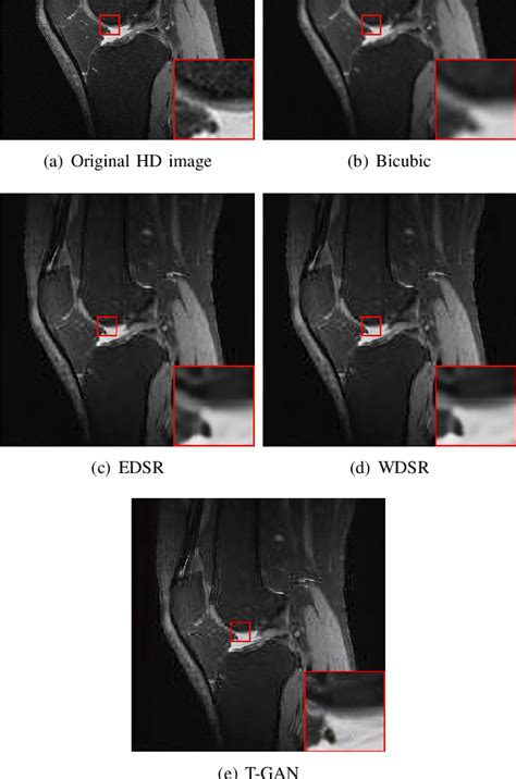 Transformer And Gan Based Super Resolution Reconstruction Network For Medical Images