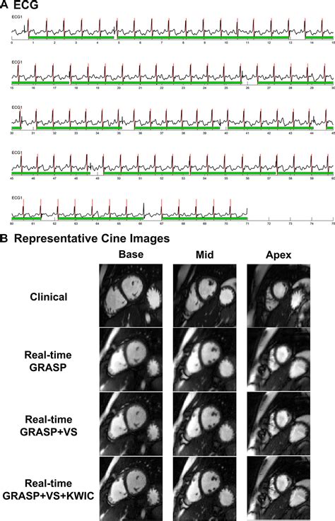 Ultra Rapid Free Breathing Real Time Cardiac Cine Mri Using Grasp