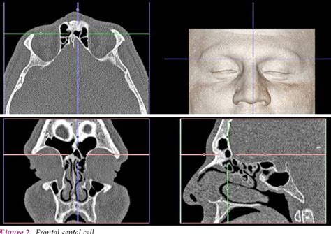 Figure 2 From Frequency Of Frontal Cells According To The International