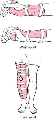 Splint Definition Of Splint By Medical Dictionary
