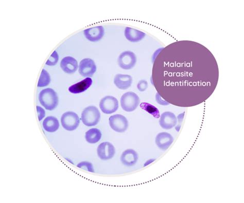 Malarial Falciparum And Vivax Antigen Mediscan Lab