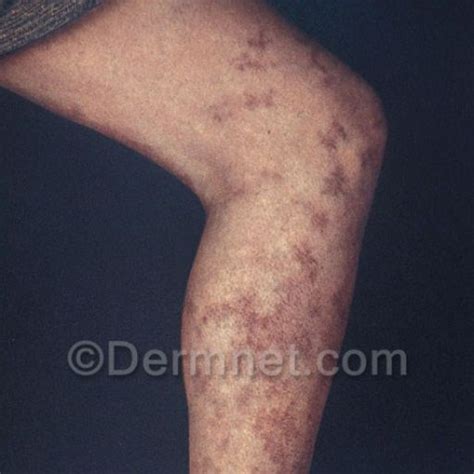 Soeb Skin Disease Vasculitis Generator · Hugging Face