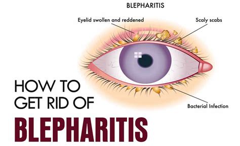 Blepharitis Home Remedies Symptoms Treatment And Prevention