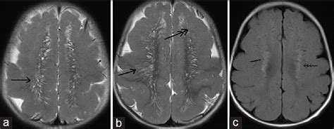 Technical Info On Pachygyria And Lissencephaly Levels Making