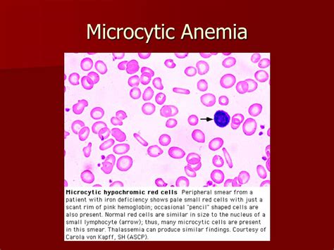 Ppt Anemia Powerpoint Presentation Free Download Id 3552810