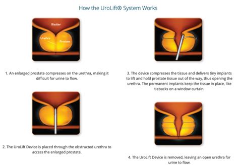 Urolift Dr Dixon Woon Urologist