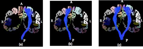 Corticospinal Tract Cst Reconstruction Based On Fiber Orientation