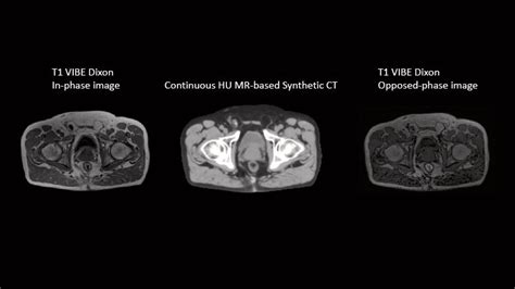 Mr Only Radiotherapy Planning Siemens Healthineers