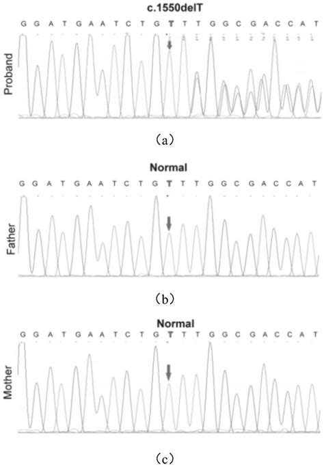 Cranial Clavicle Dysplasia Pathogenic Runx2 New Mutation Site Gene