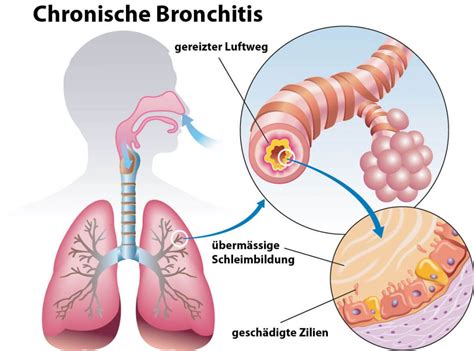 Rezidivierende Bronchitis Ursachen Symptome Und Behandlung Pzgi
