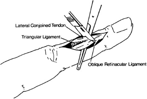 Clarification Of Extensor Tenotomy For Finger Deformities Journal Of