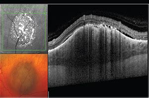 Imaging Advances For Choroidal Melanoma
