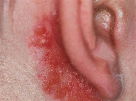 Skin Tuberculosis Signs Symptoms And Complications 49 Off