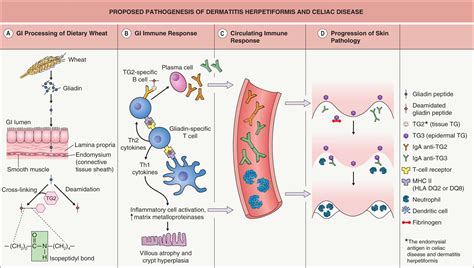 Dermatitis Herpetiformis And Linear Iga Bullous Dermatosis Clinical Tree